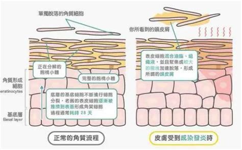头皮屑多到一挠就跟下雪一样，怎么办 知乎