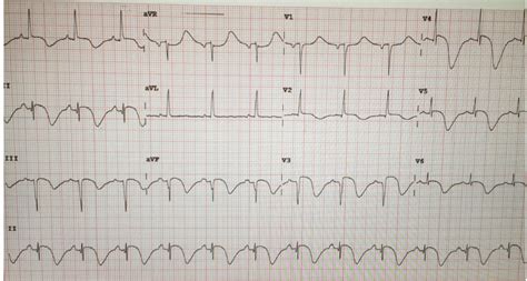 Dr Smiths Ecg Blog Bizarre T Wave Inversions In A Patient Without