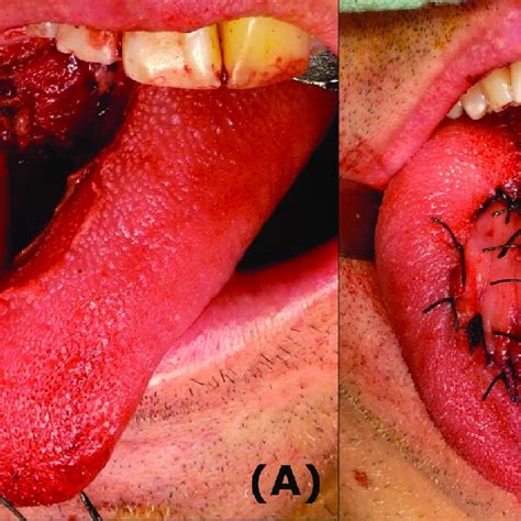 Surgical Pictures From The Partial Glossectomy And The Local Buccinator Download Scientific