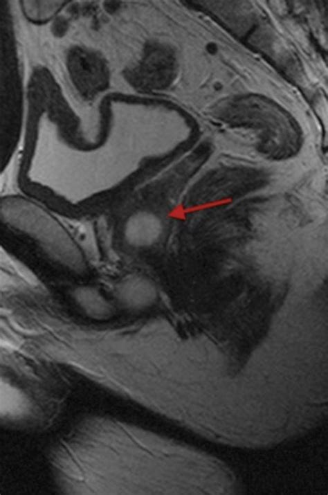 Prostatic Utricle Cyst With Chronic Prostatitis Applied Radiology
