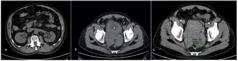 Ct Demonstrated Bilateral Obstructive Uropathy 1 A To Solid Mass