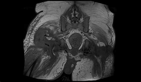 Pelvic Ostiomelitis Mri Radiology Article On Pelvic Osteomyelitis