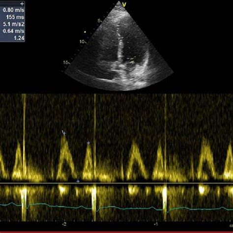 Normal Mitral Inflow Pattern E A E Early Inflow Wave A Atrial Download Scientific Diagram