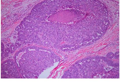 Metastasis To Scalp In 2007 A Solid Tumor Pattern Predominates Download Scientific Diagram