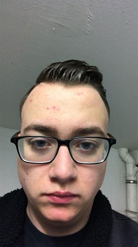 Just Wanted To Share My Mewing Progress 😗👍🏼 3 Years R Mewing