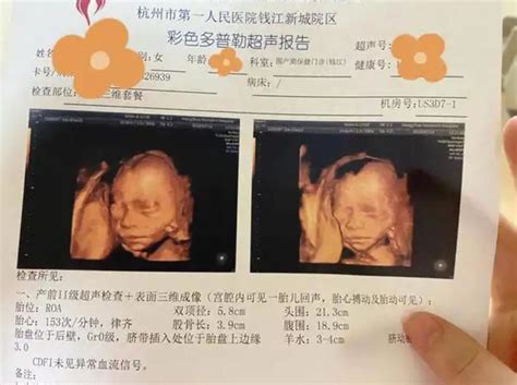 孕妈做b超时医生为啥会问老公身高？孕检时这些暗语，妈妈要清楚