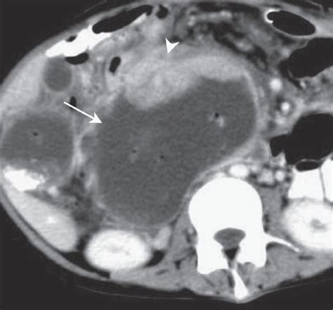 Case Report Cholangiocarcinoma In A Choledochal Cyst Abstract