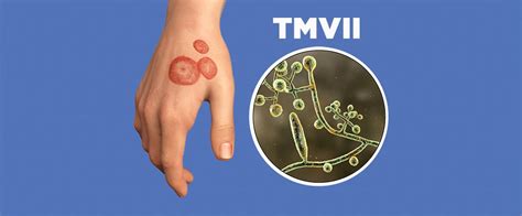 Tmvii Is A New Sexually Transmitted Fungus K Gay Desert Guide Palm