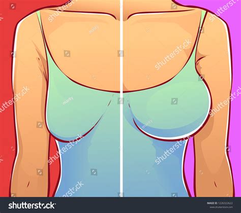 Woman Breast Beforeafter Vector Illustation Stock Vector Royalty Free