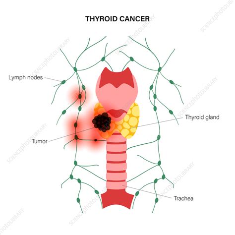 Thyroid Cancer Illustration Stock Image F036 3917 Science Photo