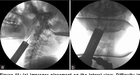 Figure 11 From Endoscopic Anterior Odontoid Screw Fixation For The