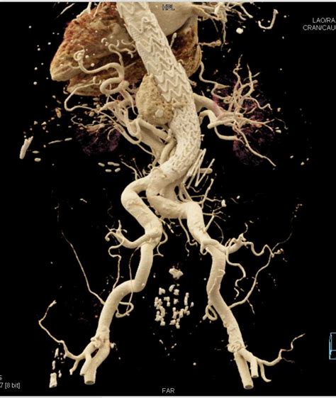 Bypass Grafting To The Superior Mesenteric Artery Sma Vascular