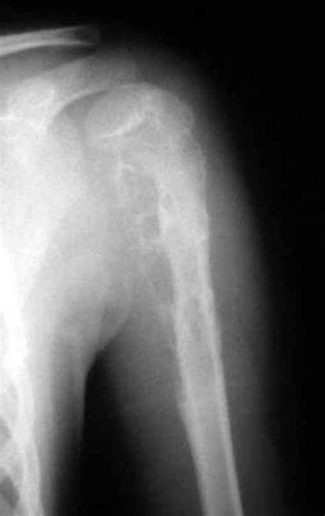 Sarcoma De Ewing Do úmero Em Criança