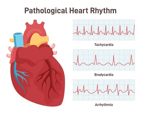 Lifestyle Modifications For Managing Arrhythmia The Harley Street