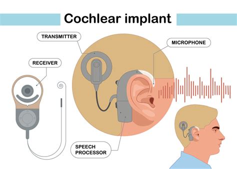 Cochlear Implants News Sports Jobs The Express