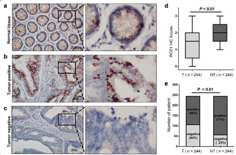 IHC Analysis Of RCE1 Expression In CRC Tumor And Adjacent Non Tumorous