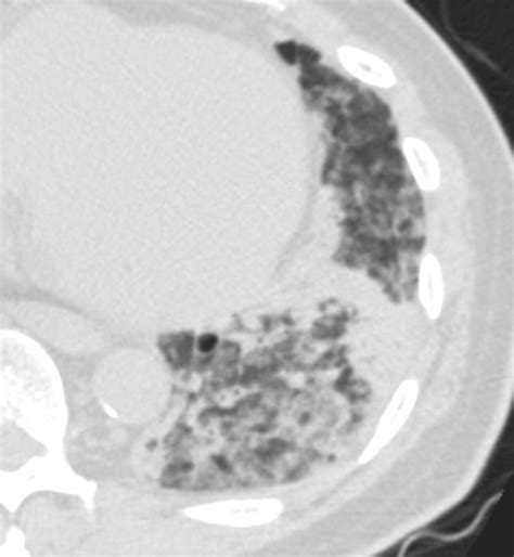 173lu Hypersensitivity Pneumonitis Hp Lungs