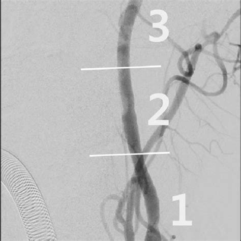 Pdf Advantages And Disadvantages Of The Envoy 6f Distal Access Guiding Catheter In