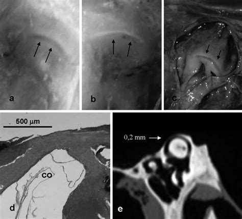 Peculiaridades Anatómicas Del Canal Semicircular Superior Y Su Posible