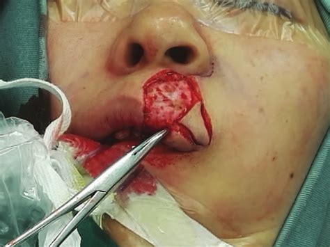 The Upper Lip Defect After Excision Download Scientific Diagram