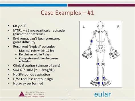 2015 Acreular Gout Classification Criteria Published Simultaneously In