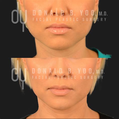 How Many Units Of Botox Does It Take To Reduce A Masseter Beverly