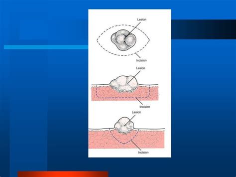 Principles And Techniques Of Biopsy Ppt