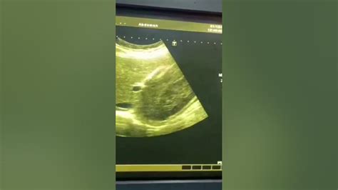 Gall Bladder Usg Youtube