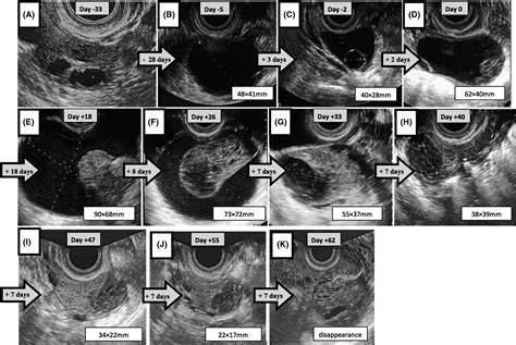 Cureus A Case Of Hemorrhagic Ovarian Cyst Rupture Nec