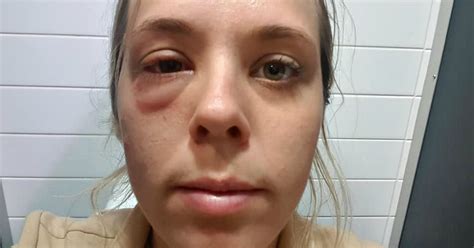 Mum With Nut Allergy Calls For Change After Suffering Reaction On A Flight