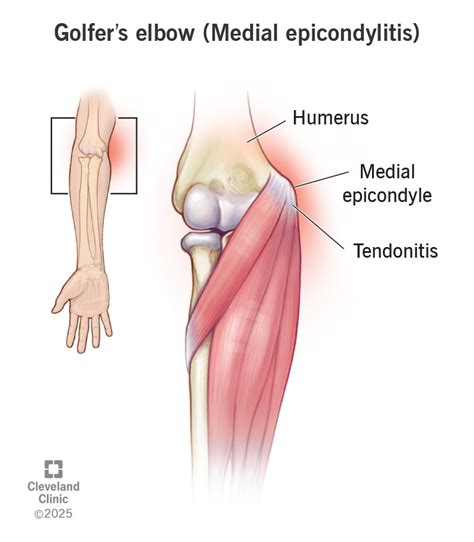 Tendinitis Medial Epicondylitis Climbers Elbow Or Golfers Elbow Krhc