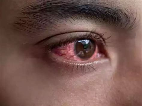 Eye Flu Myth Busters Does Eye Flu Spread By Looking In Hindi Kya Dekhne