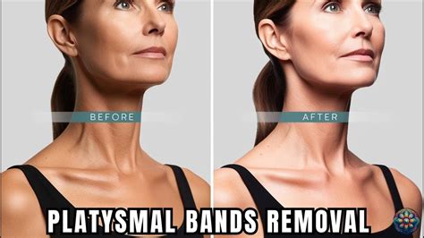 Smooth Platysmal Bands Naturally Botox Free Energy Neck Lift Solution
