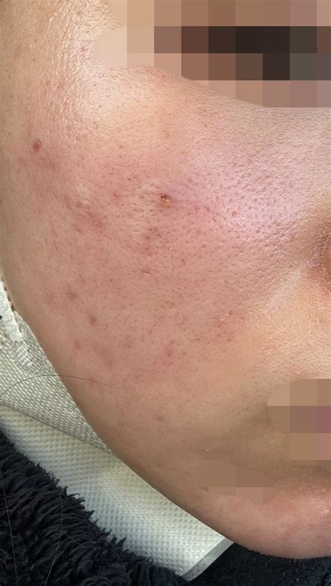 의사에게 물어보세요 여드름 자국 고 강남언니 1등 성형수술and피부시술 정보앱