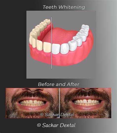 Cosmetic Dentist Nyc Dr Sachar