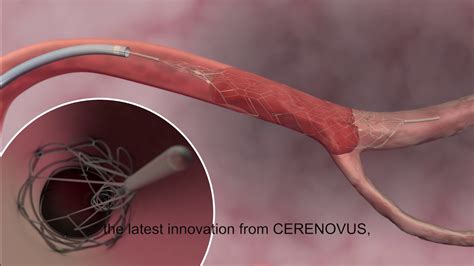 Embotrap Ii Revascularization Device Animation095197 180716 Youtube
