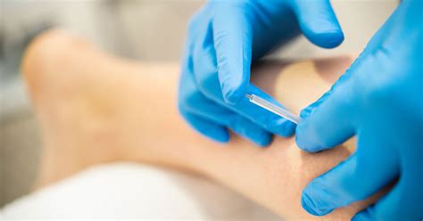 Dry Needling In Physical Therapy Institute Of Clinical Excellence