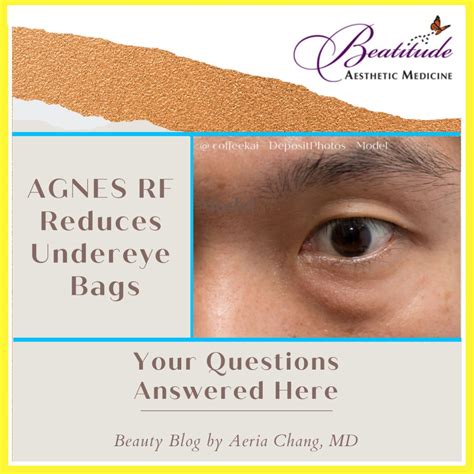 Get Rid Of Under Eye Bags With Agnes Rf Under Eye Bags Eye Bags