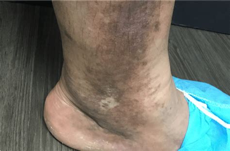 Skin Ulcer Leg