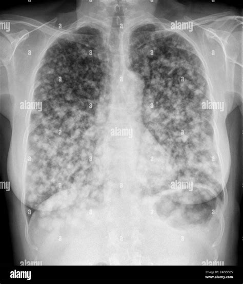 Secondary Lung Cancer Chest X Ray Of A Section Through The Lungs Dark