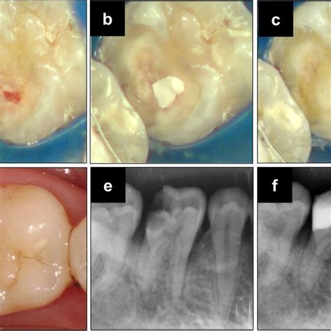 Presentation Of Radiographs In 3 Cases A B No Dentin Bridge Formation