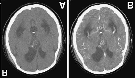 Computed Tomography Scans Showing The Mass As Mixed Signal With Fine Download Scientific