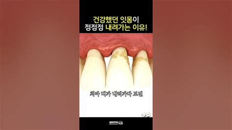 건강했던 잇몸이 점점점 내려가는 이유 치주염 Youtube