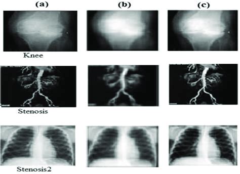Denoising By The Gaussian And Skcs Kernels In Spatial Domain Corrupted