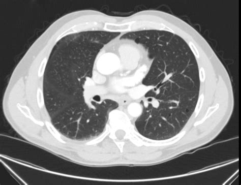 Accessory Fissures Lungs