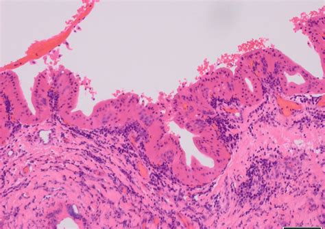 Laryngocele Histology