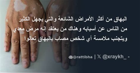 البهاق من أكثر الأمراض الشائعة والتي يجهل الكثير من الناس عن أسبابه