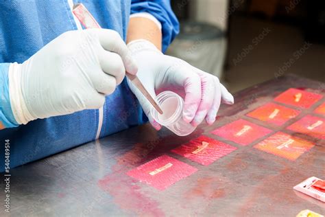 Biopsy Samples Being Processed At The Pathology Laboratory To Be Embedded In Paraffin For