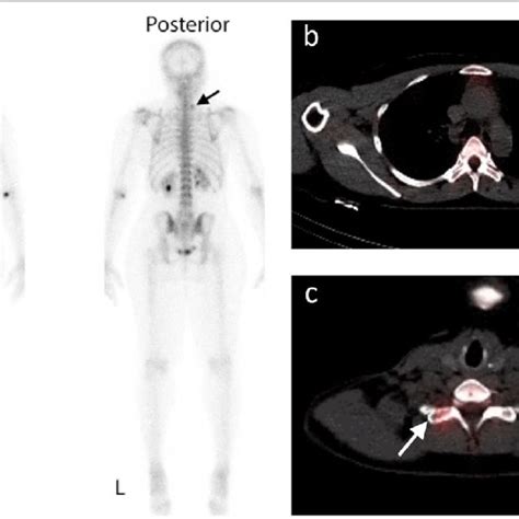 Planar Bone Scan Versus Spect Images From A Planar Bone Scan A And