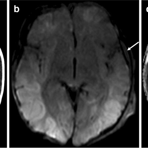 Selected Cranial Imaging In A 5 Month Old Girl A The Axial Head Ct Download Scientific Diagram